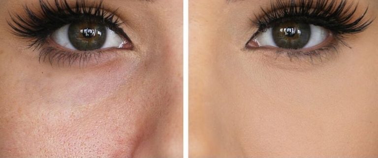 How to Get Rid of Oily Skin: 17 Best Home Remedies That Really Work ...