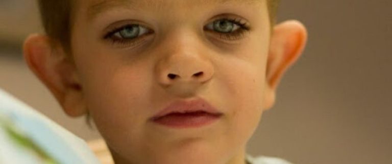 Fragile X Syndrome: Causes, Symptoms and Treatments - High Rated Gabru