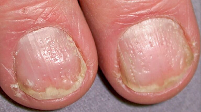 Psoriasis Disease: Symptoms, Causes, Diagnosis, Treatment and Home ...